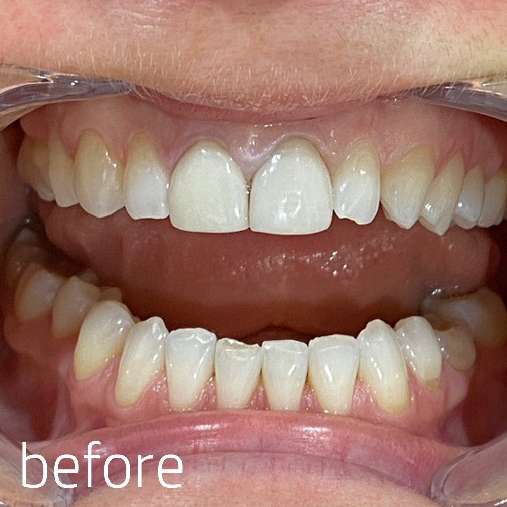 Custom Crowns & Veneers - iDental Surgery®